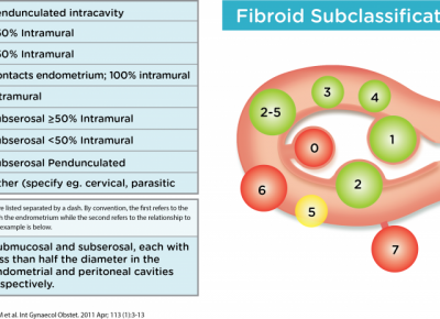 Fibroids - Anthony Siow