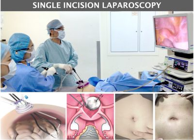 Fibroids - Anthony Siow