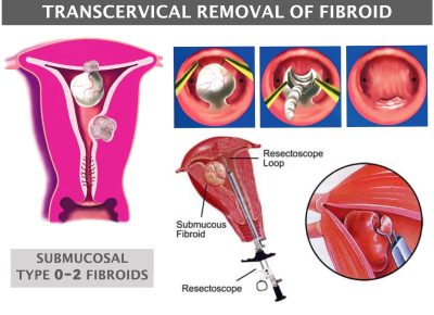 Fibroids - Anthony Siow