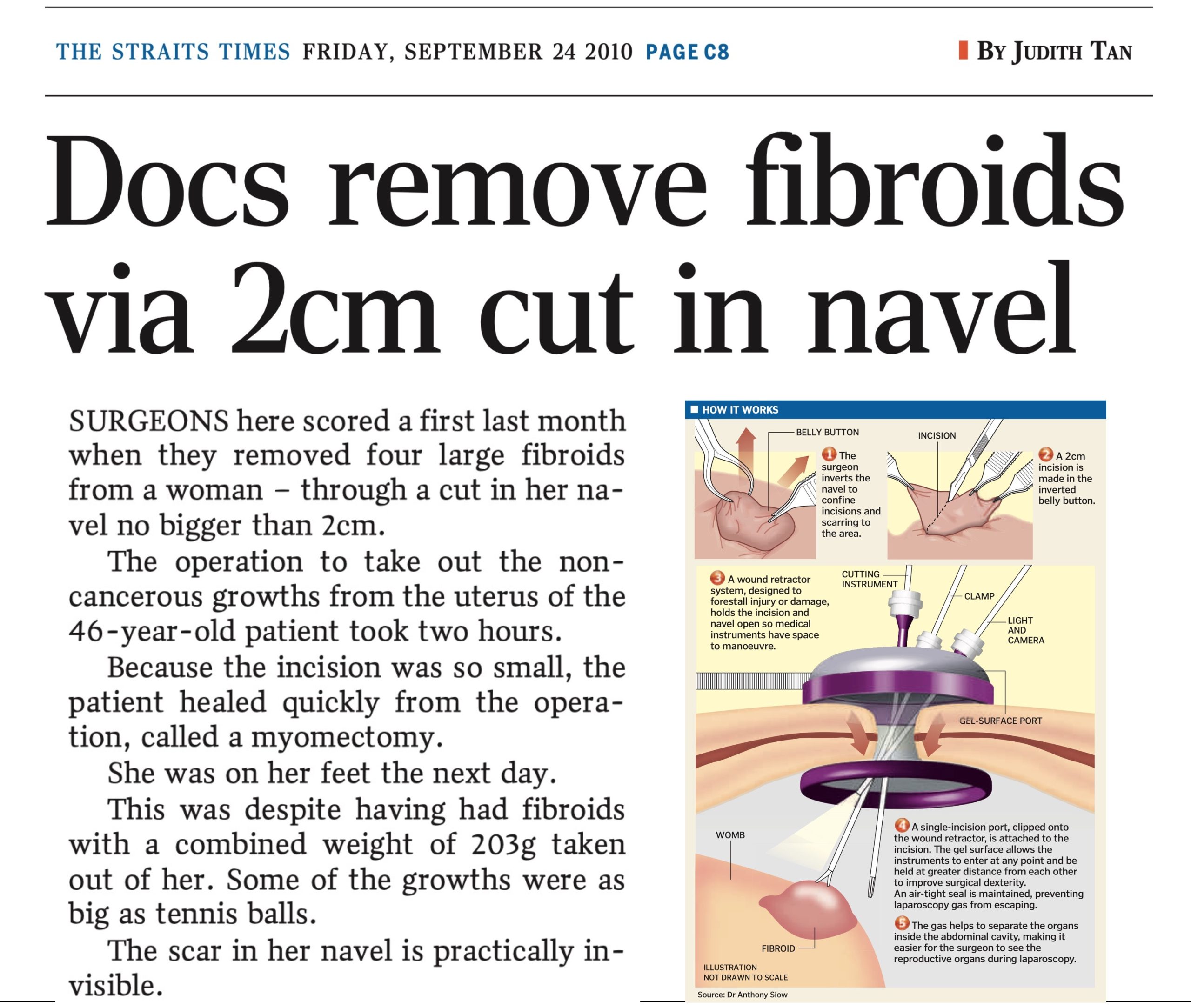 Single Incision Laparoscopy - Landmark Cases - Anthony Siow