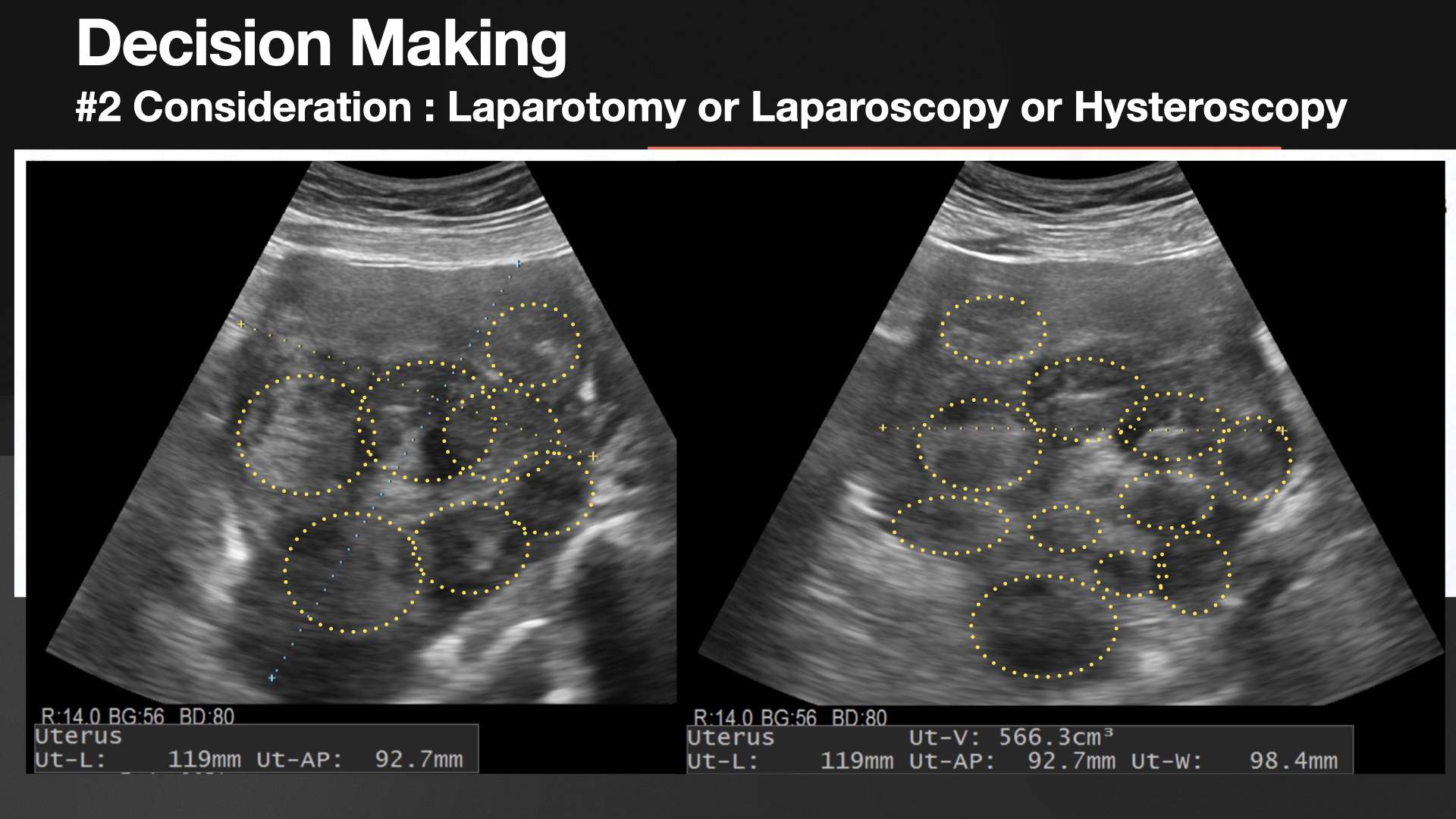 Fibroid Treatment & Surgery 2024 - Anthony Siow