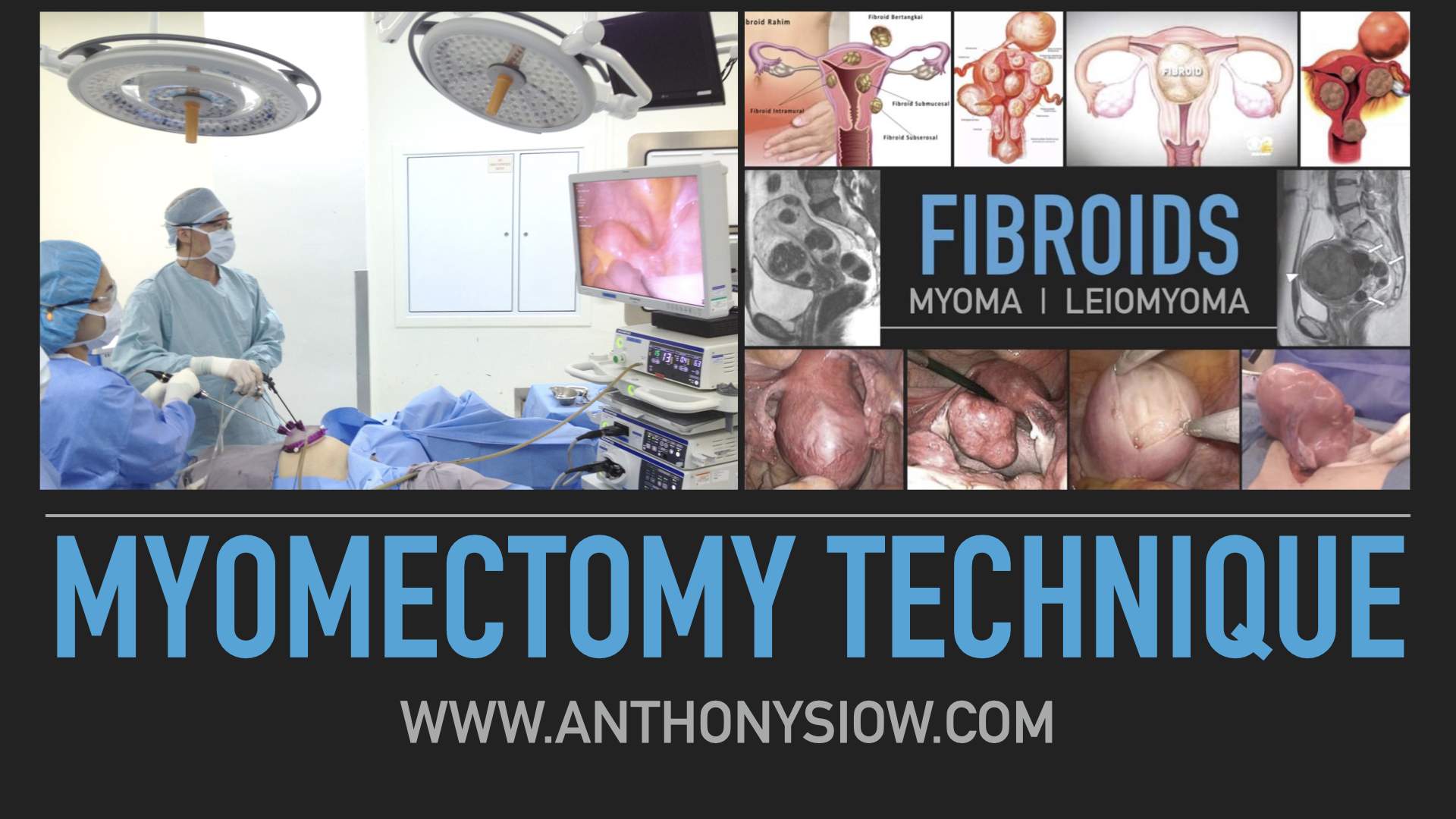Fibroid Treatment & Surgery 2024 - Anthony Siow