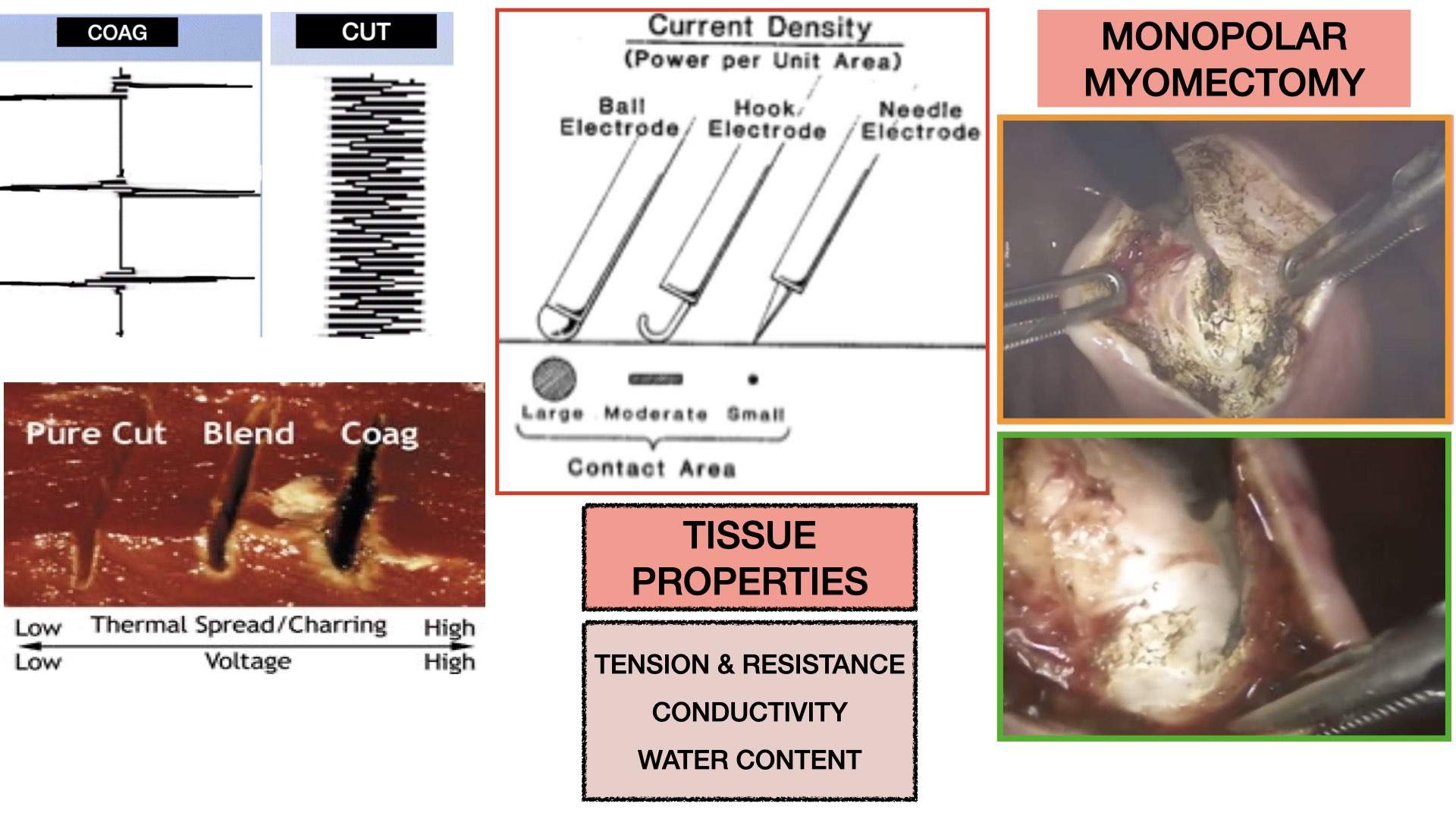 Mastering Surgical Energy for Laparoscopic Myomectomy - Anthony Siow